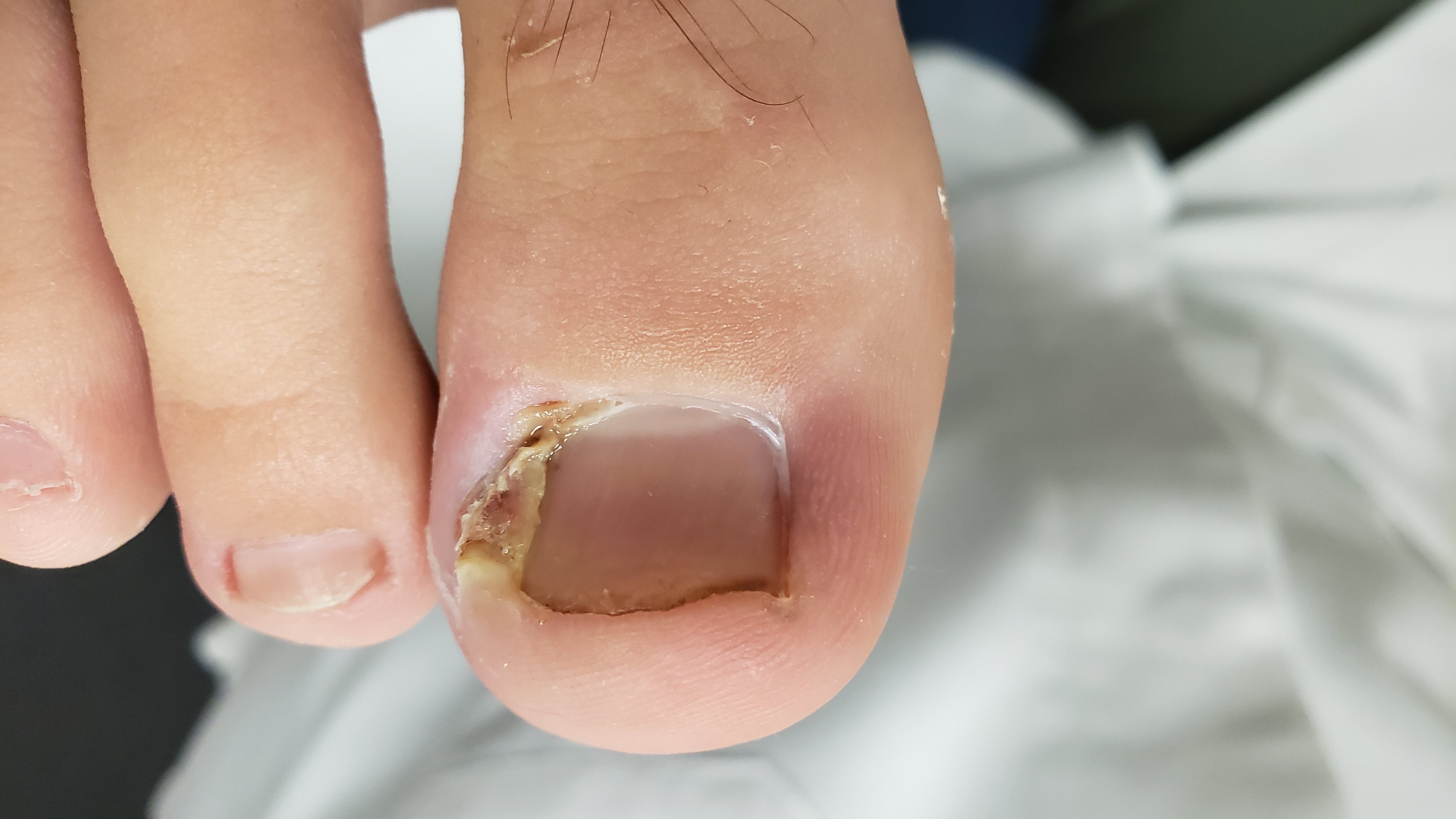 Toenails Only Growing On One Foot On Sale Emergencydentistry